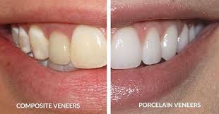Transform Your Smile: A Comprehensive Guide to Composite and Porcelain ...